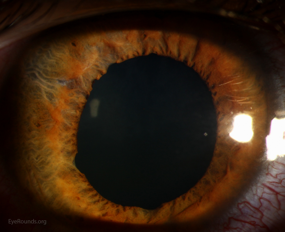 Critical Cases - Traumatic mydriasis! | EM Daily